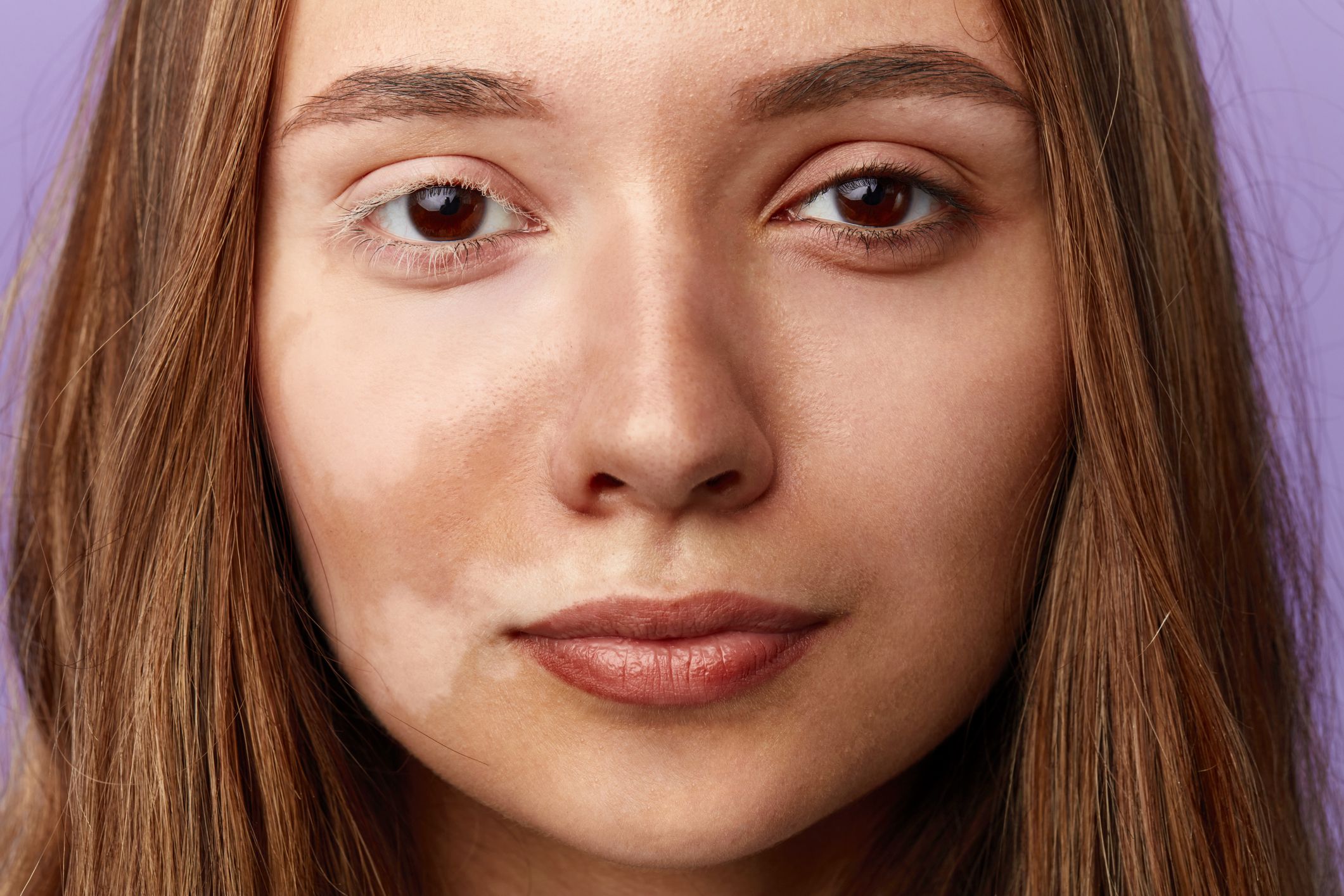 Depigmentation On Face - What You Need to Know - Health Information World